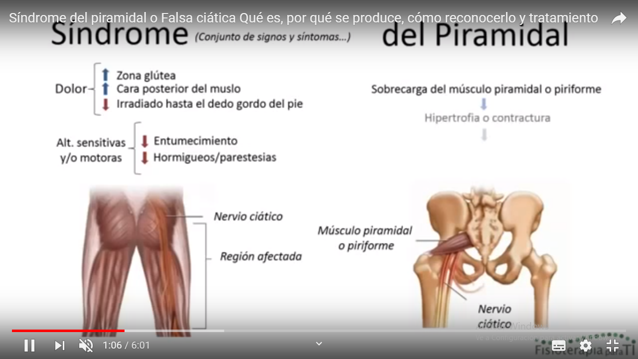 Síndrome del Musculo Piramidal o falsa ciatica – Enriquerubio.net