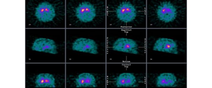 Eficacia y seguridad del 123I-ioflupano (DaTSCAN©) en el diagnóstico de ...