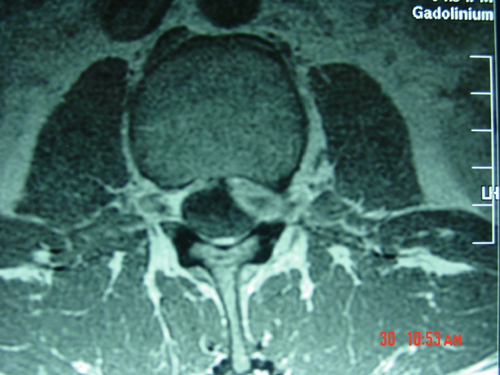 Radiculopatia Herpetica La inflamación del ganglio raquideo ...